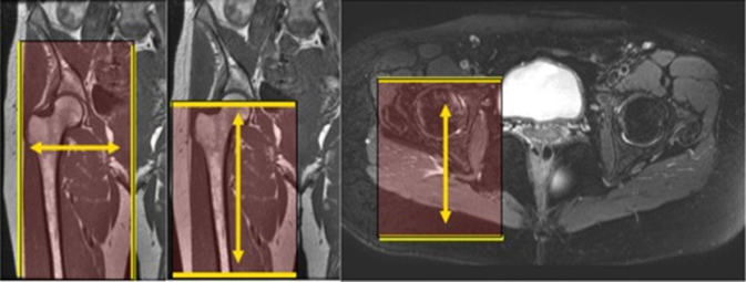 MRI Pelvis Hamstring WO MSK Protocol | OHSU